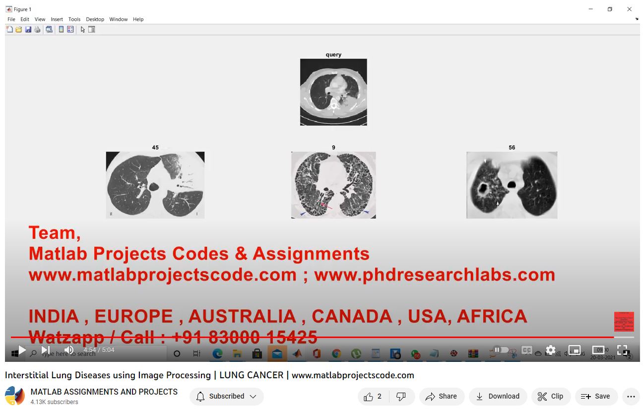 Interstitial Lung Diseases using Image Processing _ LUNG CANCER